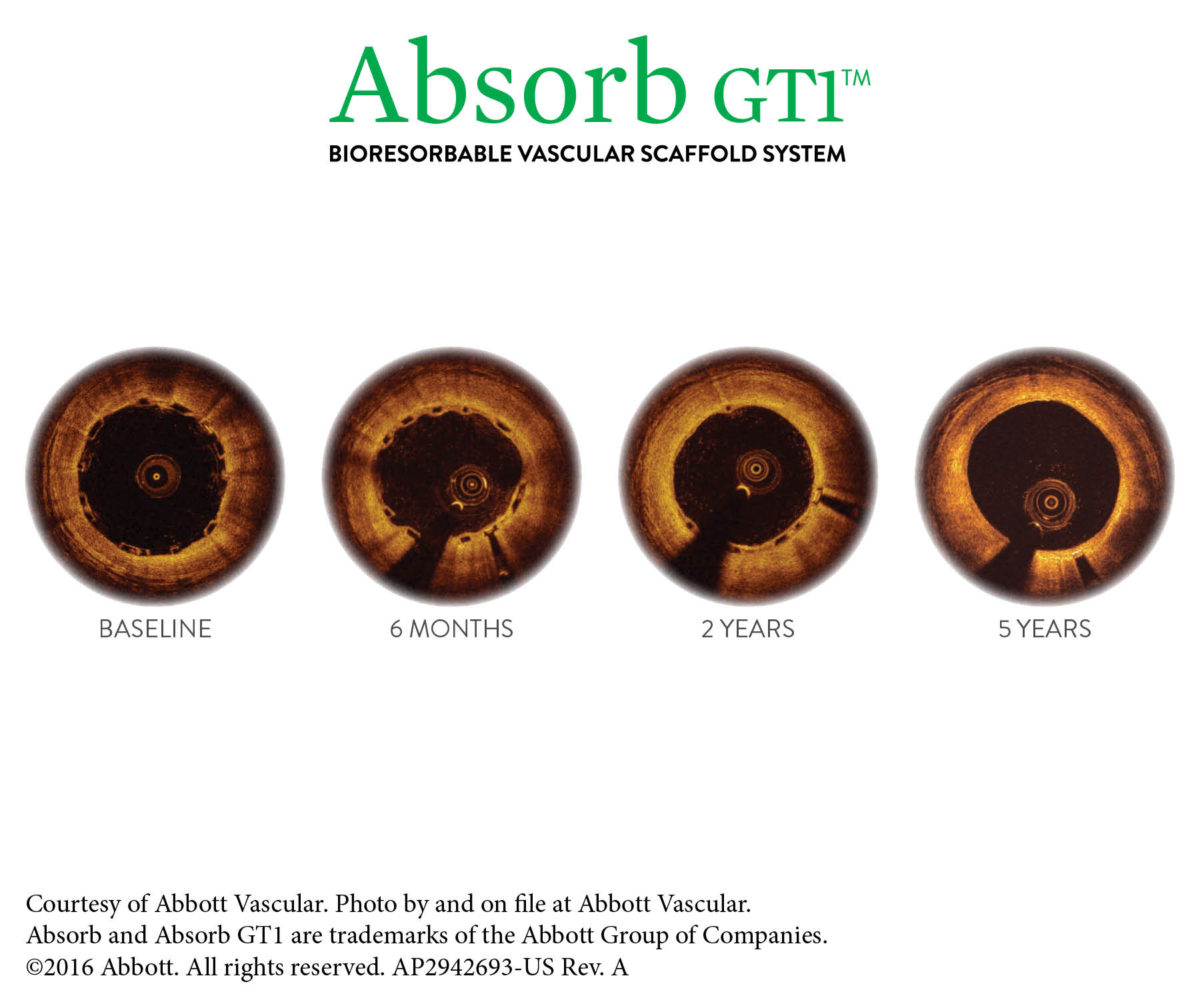 The Arrival of the Organic Stent